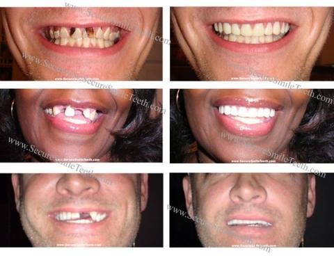 Secure Smile Teeth Cosmetic Fake At Home Dental Makeover