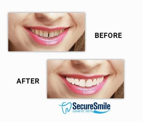 Secure Smile Teeth Cosmetic Fake At Home Dental Makeover